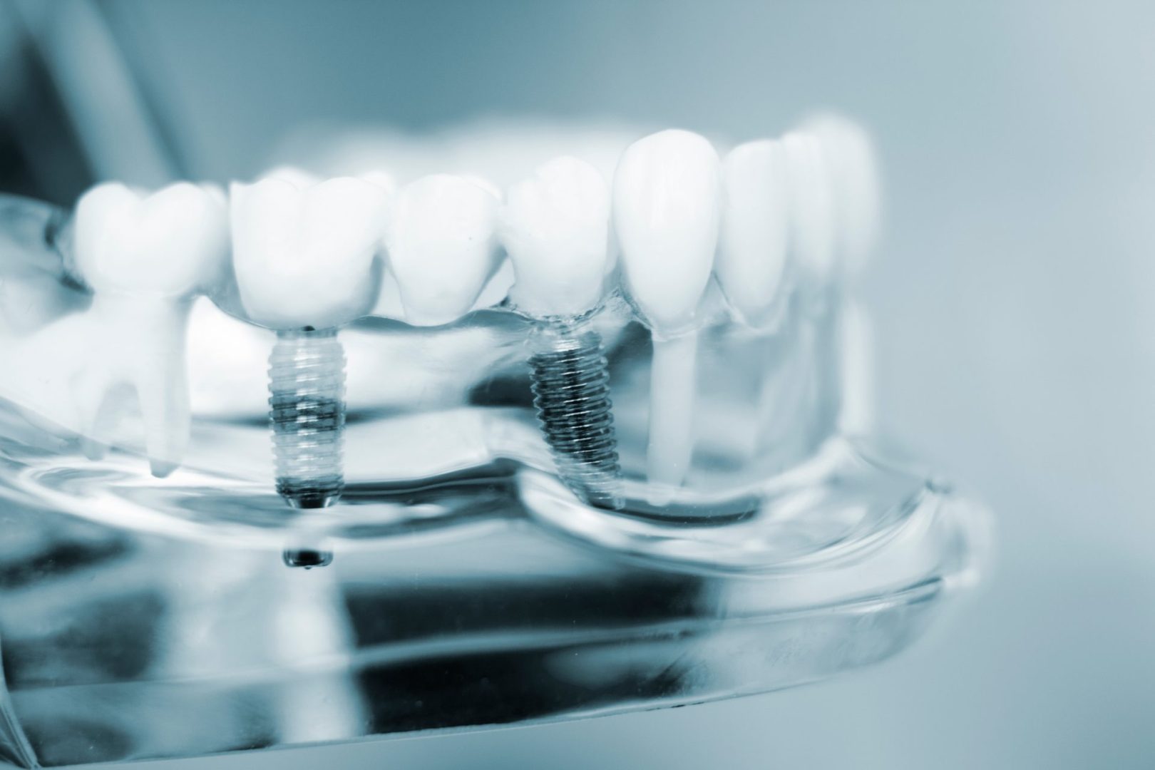 Dental Implants – Cardinal Point Dental